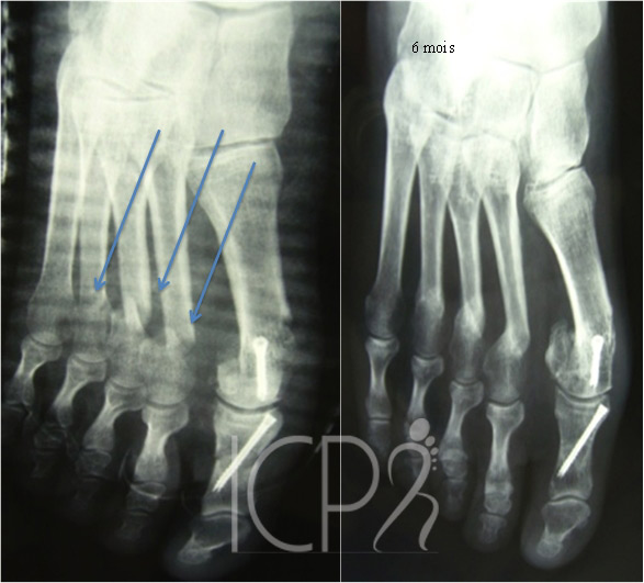 ICPR pathologie Métatarsalgies