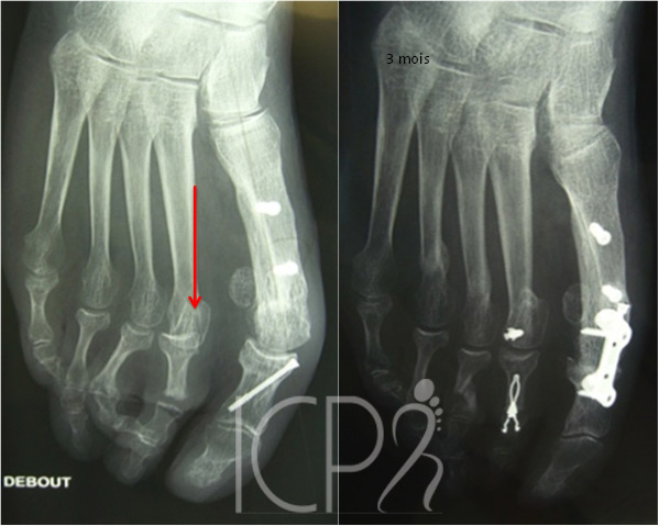 ICPR pathologie Métatarsalgies